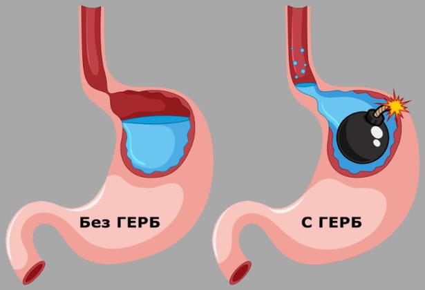 Какво е гастроезофагеална рефлуксна болест (ГЕРБ)? - Искра.бг Https ...